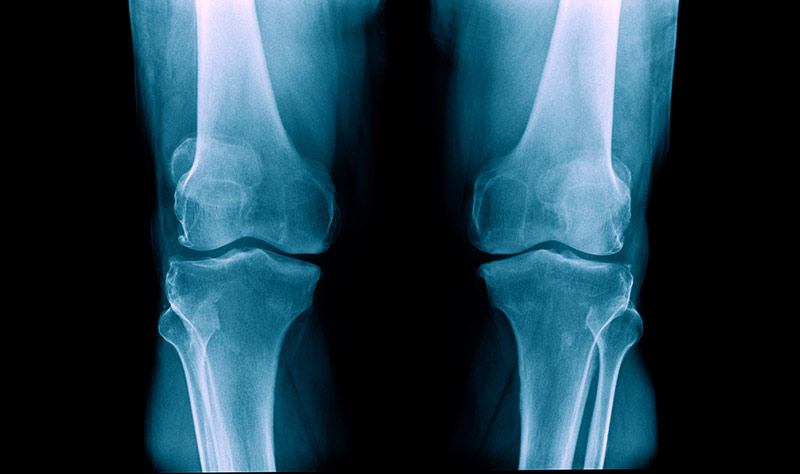 OA of the Knee Clinical Study in Phoenix, Arizona